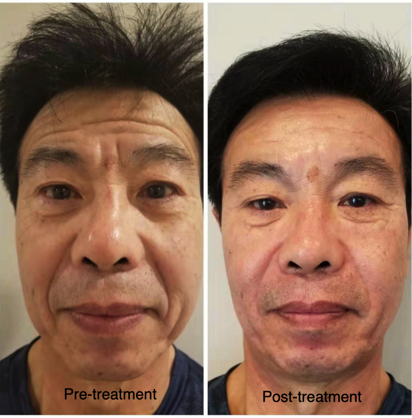 Platelet-Rich Plasma (PRP) - Premier MedSpa VA